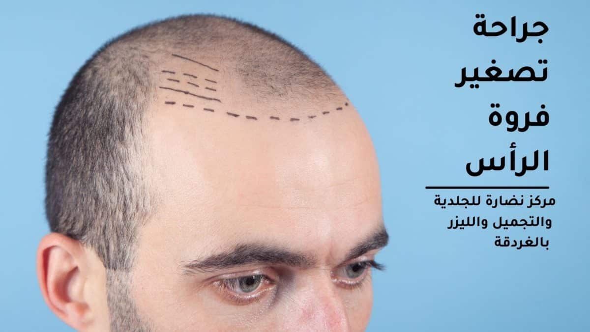 Scalp Reduction Surgery | Freshness center for dermatology, laser and ...