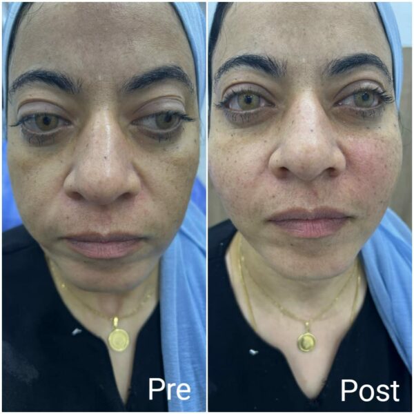 Plasma filler injections for the face and its most important benefits ...