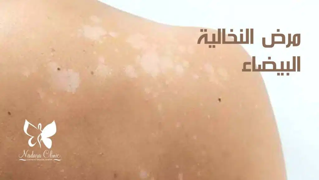 pityriasis alba; white spot treatment