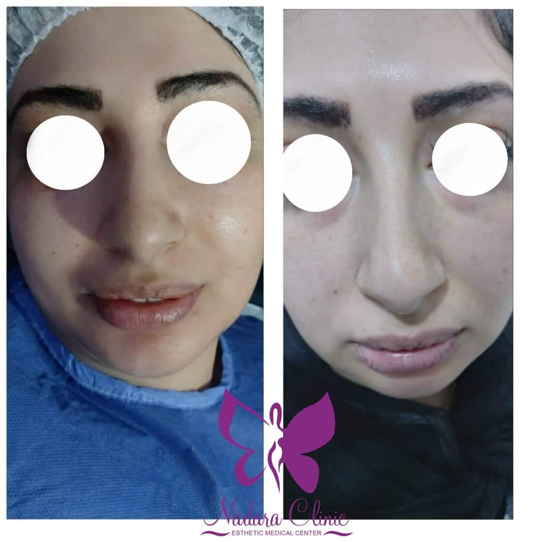 Fat injection in Hurghada | Book Now | Nadara Clinic