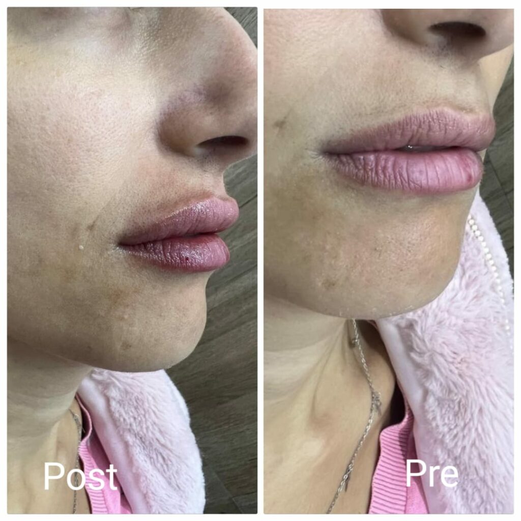 Lip contouring with fillers in Hurghada - Book now - Nadara Dermatology ...