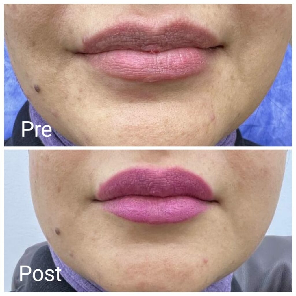 Plasma Filler in Hurghada - Book Now - Nadara Center