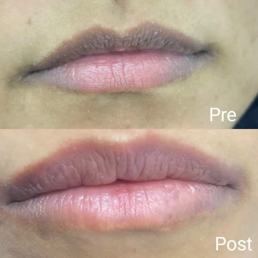 Laser treatment for lip pigmentation in Hurghada - Book now - Nadara Center