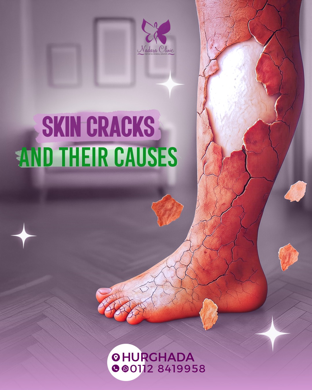 Cracked skin and its causes - Nadara Clinic